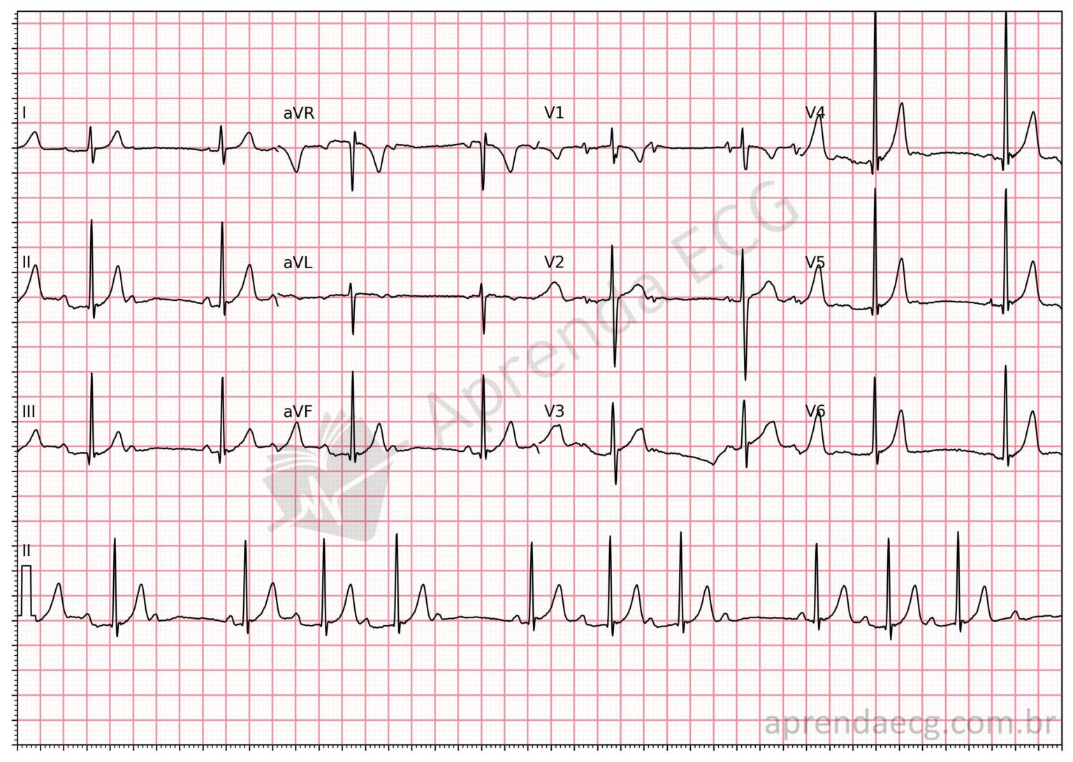 Fenômeno de Wenckebach: O Que Você Precisa Saber - Aprenda ECG | Doctor ...