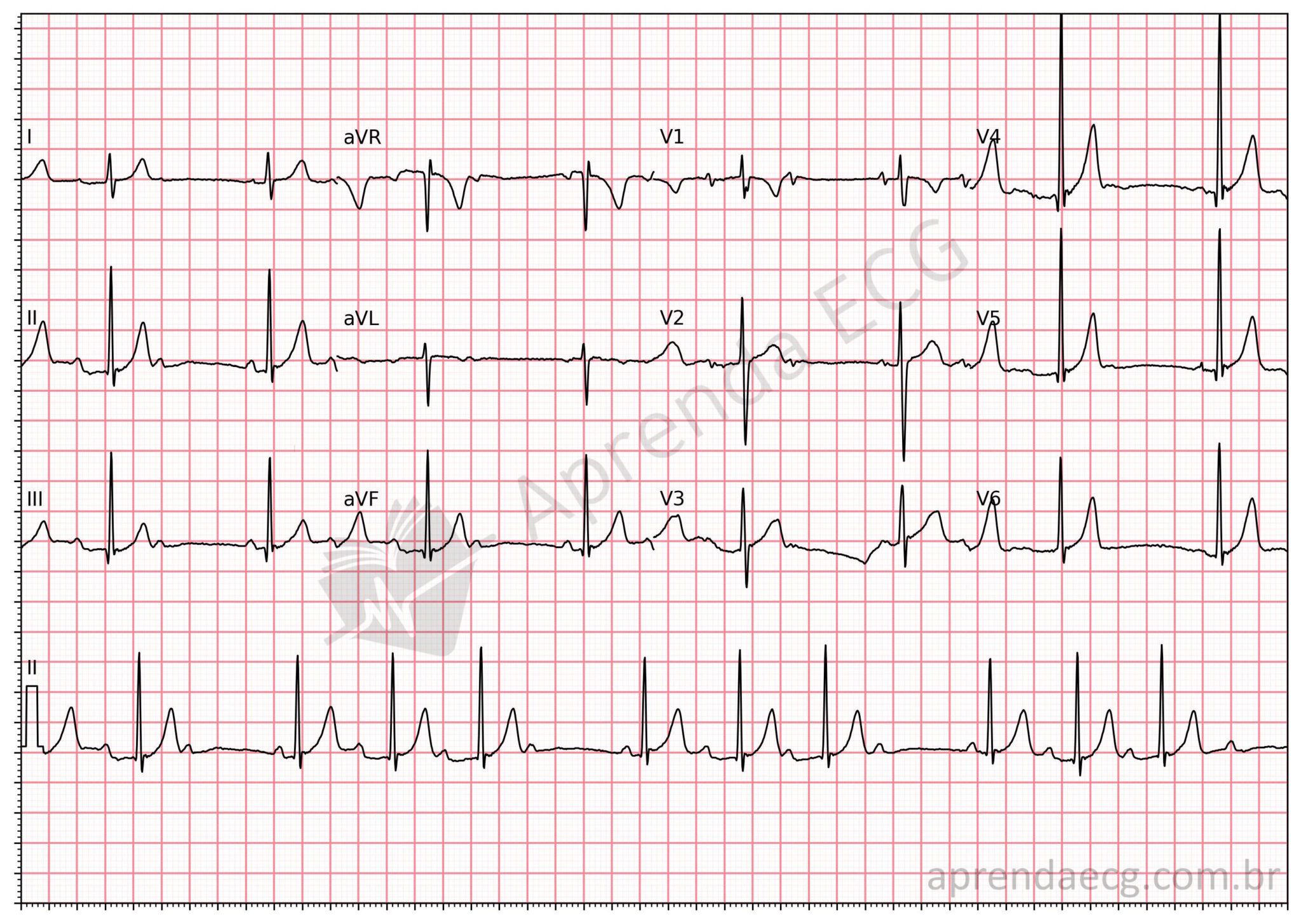 Fenômeno de Wenckebach: O Que Você Precisa Saber - Aprenda ECG | Doctor ...