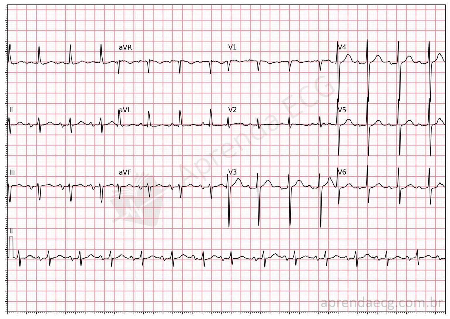 Bloqueio Interatrial - Aprenda ECG | Doctor Quest
