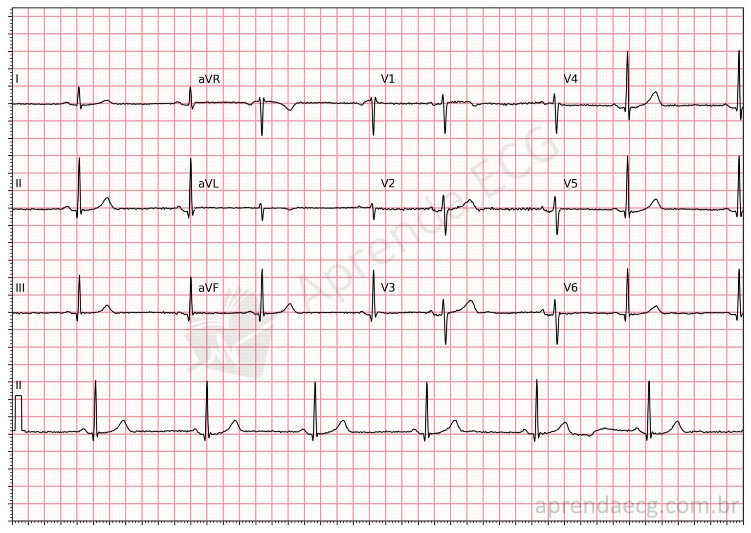 Bradicardia Sinusal - Aprenda ECG