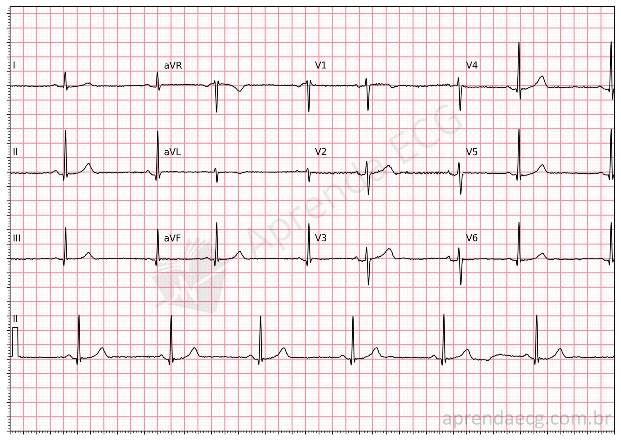 Bradicardia Sinusal - Aprenda ECG
