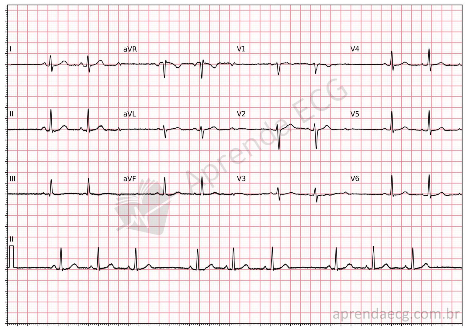 Bloqueio Sinoatrial - Aprenda ECG