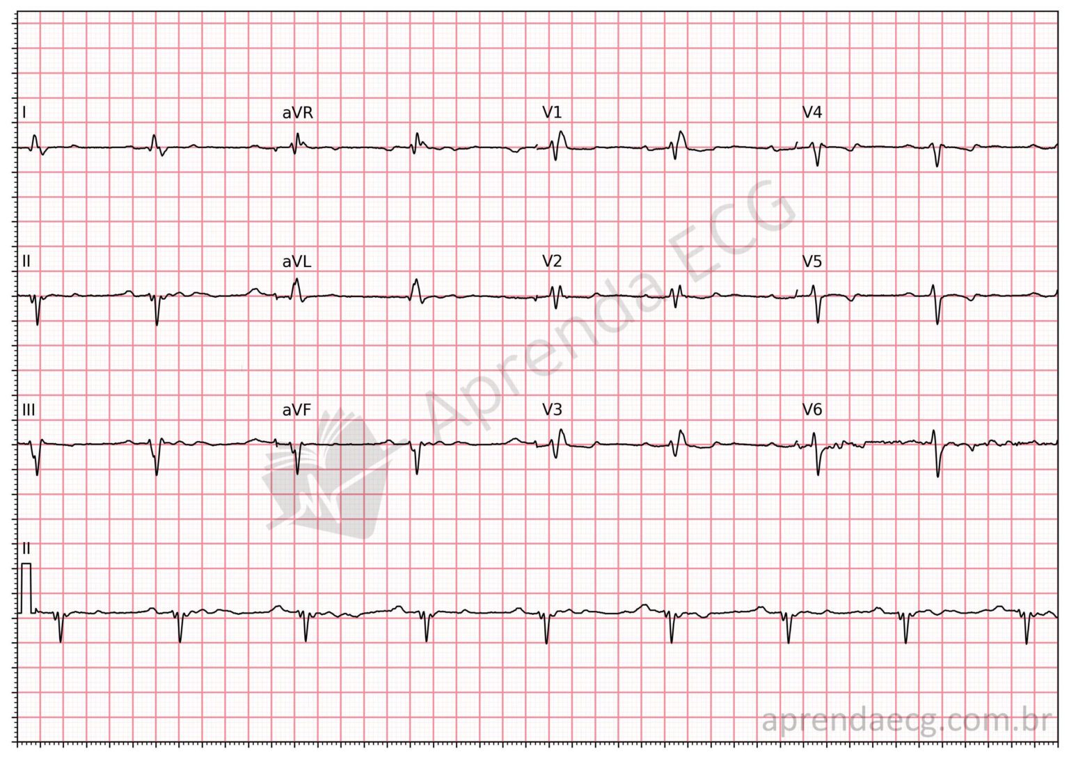 Doença de Chagas - Aprenda ECG