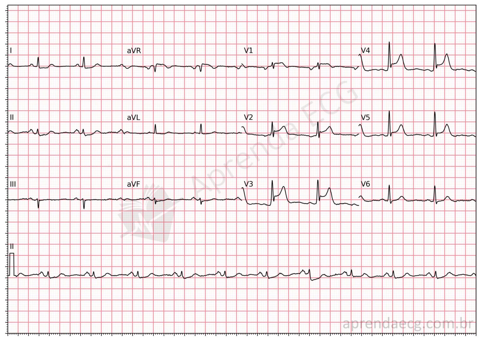 Distorção Terminal do QRS - Aprenda ECG