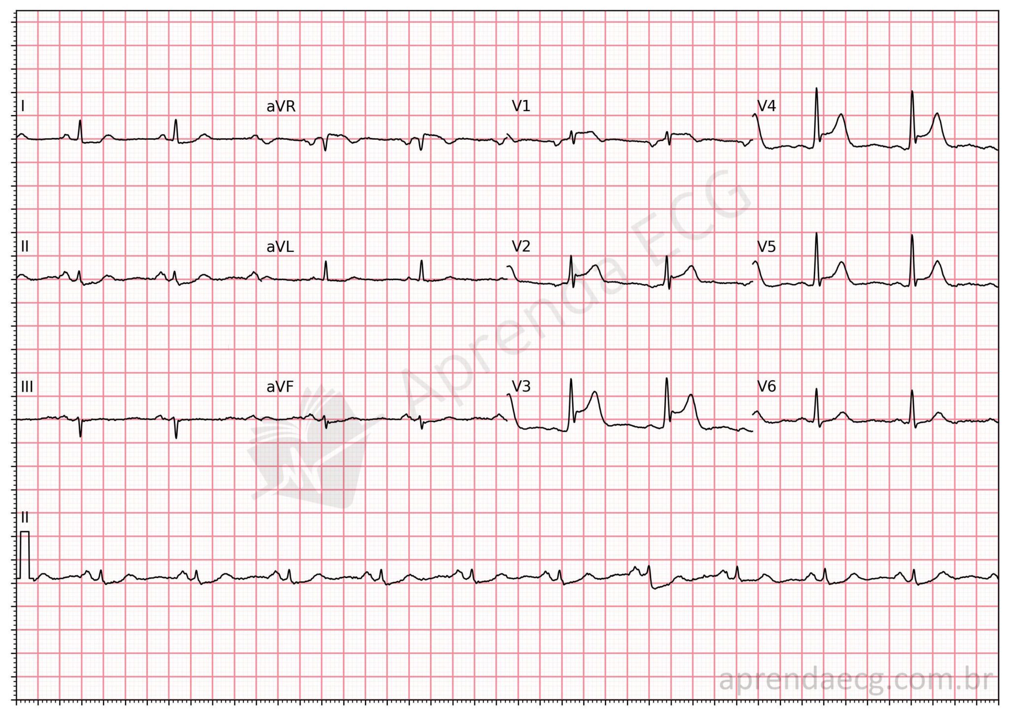 Distorção Terminal do QRS - Aprenda ECG