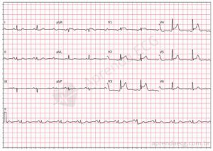 Distorção Terminal do QRS - Aprenda ECG