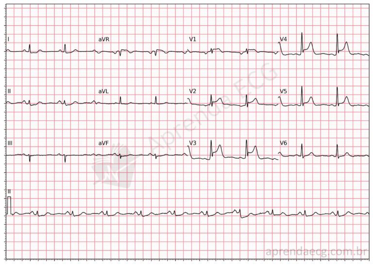 Distorção Terminal do QRS - Aprenda ECG
