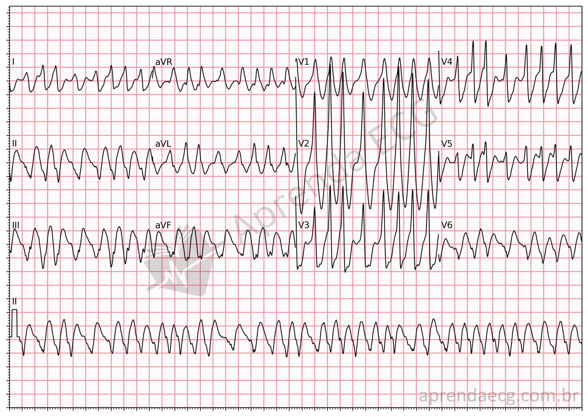 Fibrilação Atrial Pré-excitada - Aprenda ECG