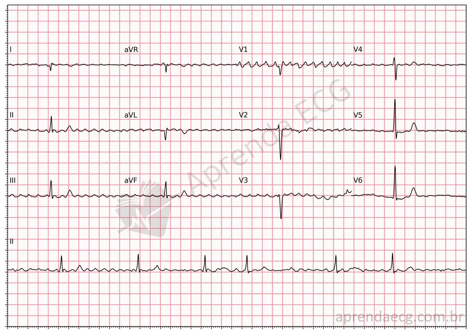 Fibrilação Atrial - Aprenda ECG