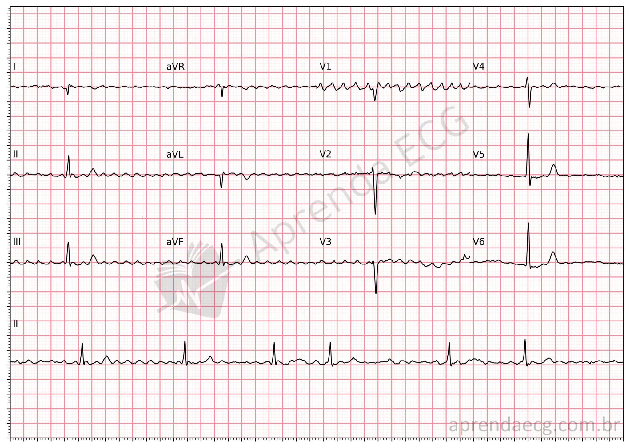 Fibrilação Atrial - Aprenda ECG