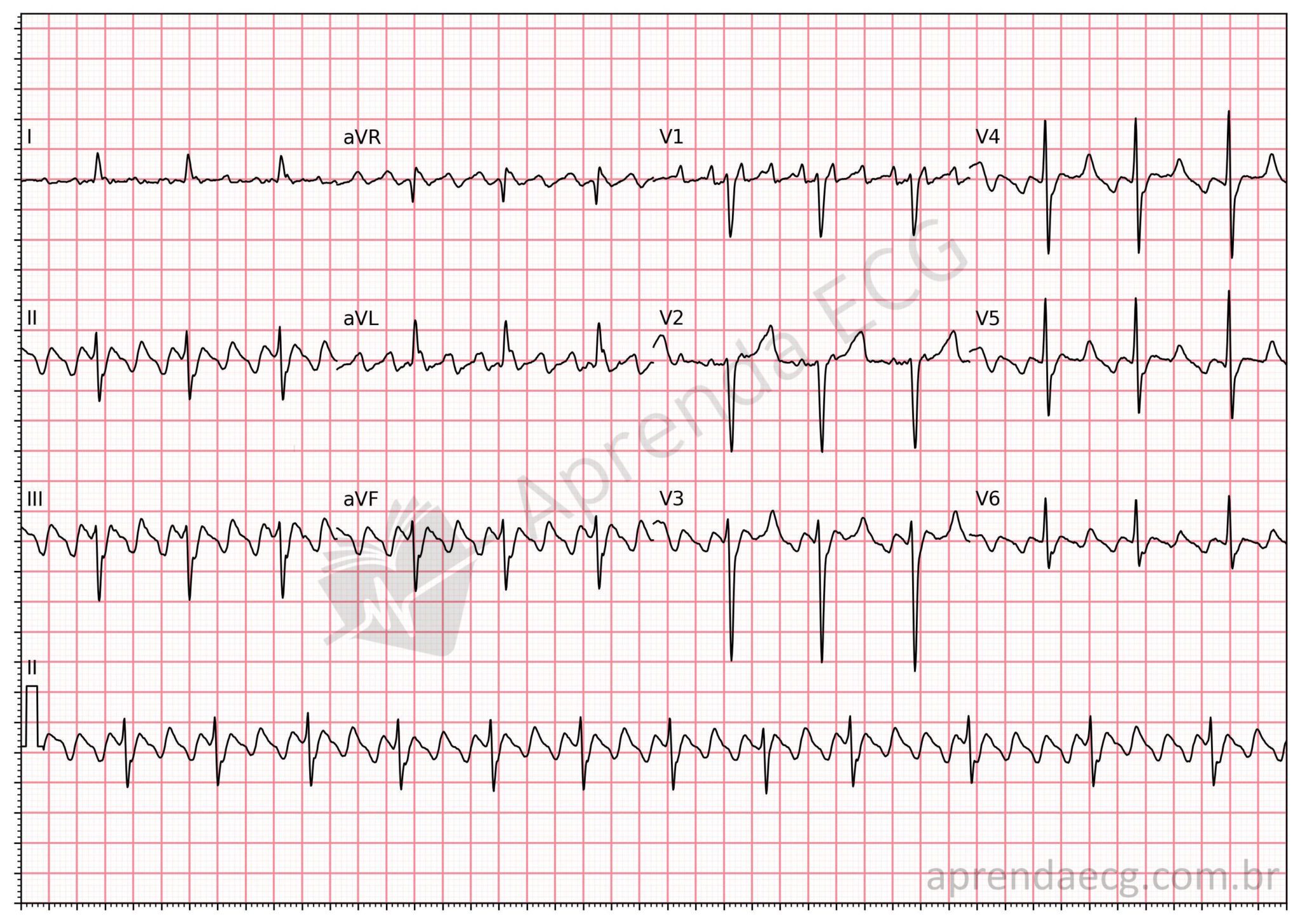 Flutter Atrial: guia completo para acadêmicos de medicina - Aprenda ECG