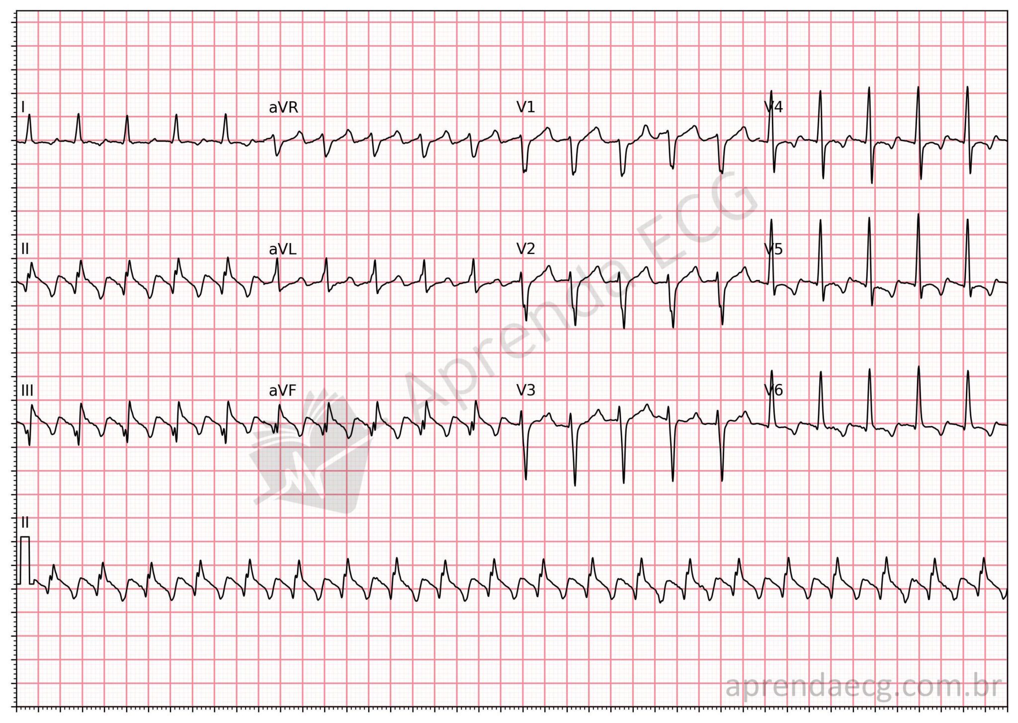Flutter Atrial - Aprenda ECG