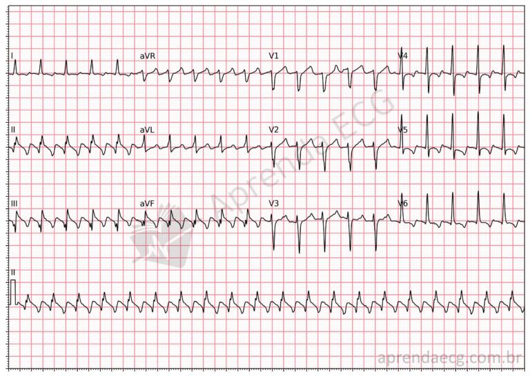 Flutter Atrial - Aprenda ECG