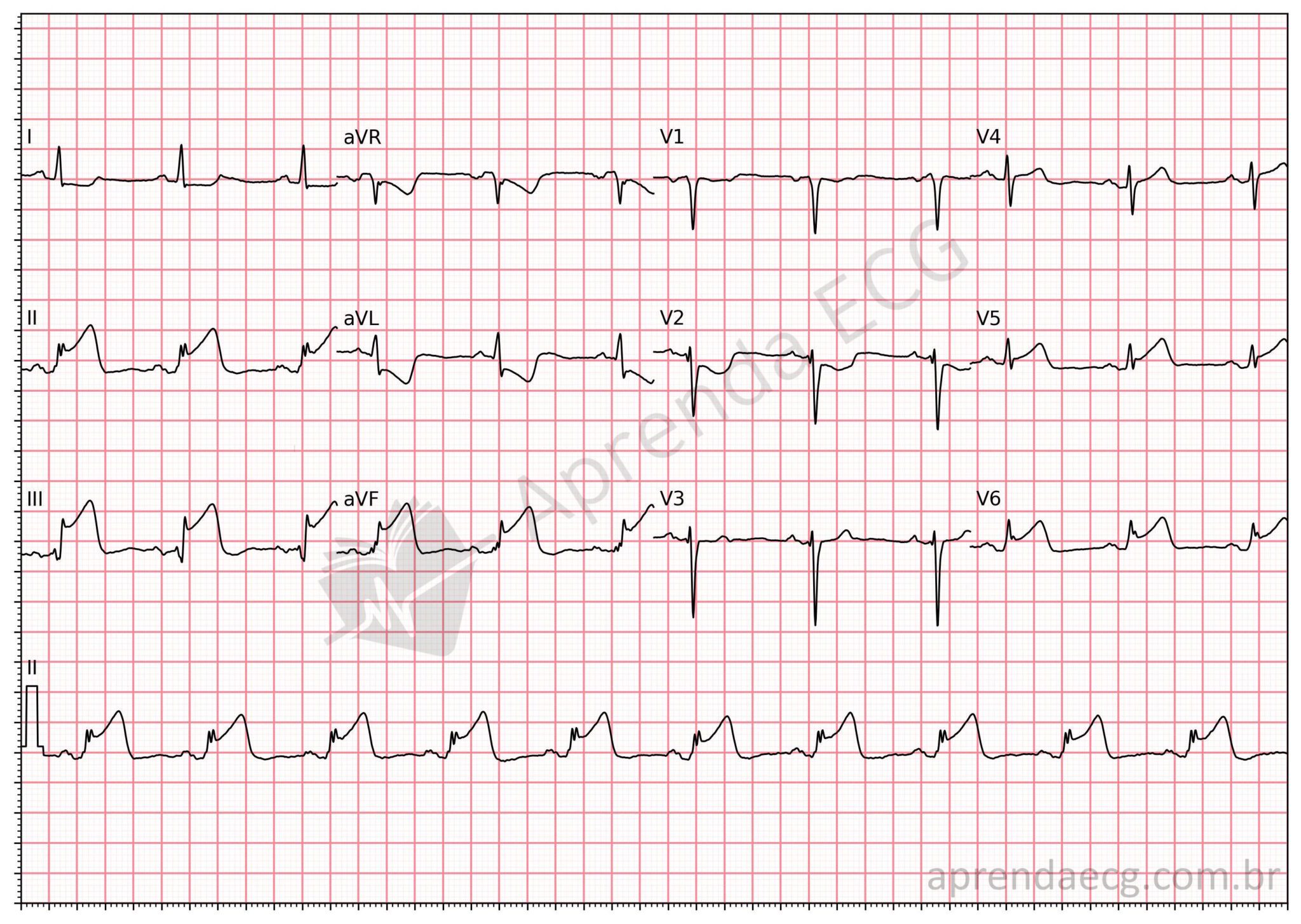 Supradesnivelamento do Segmento ST - Aprenda ECG
