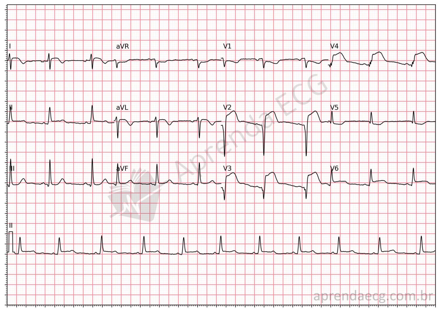 Supradesnivelamento do Segmento ST - Aprenda ECG
