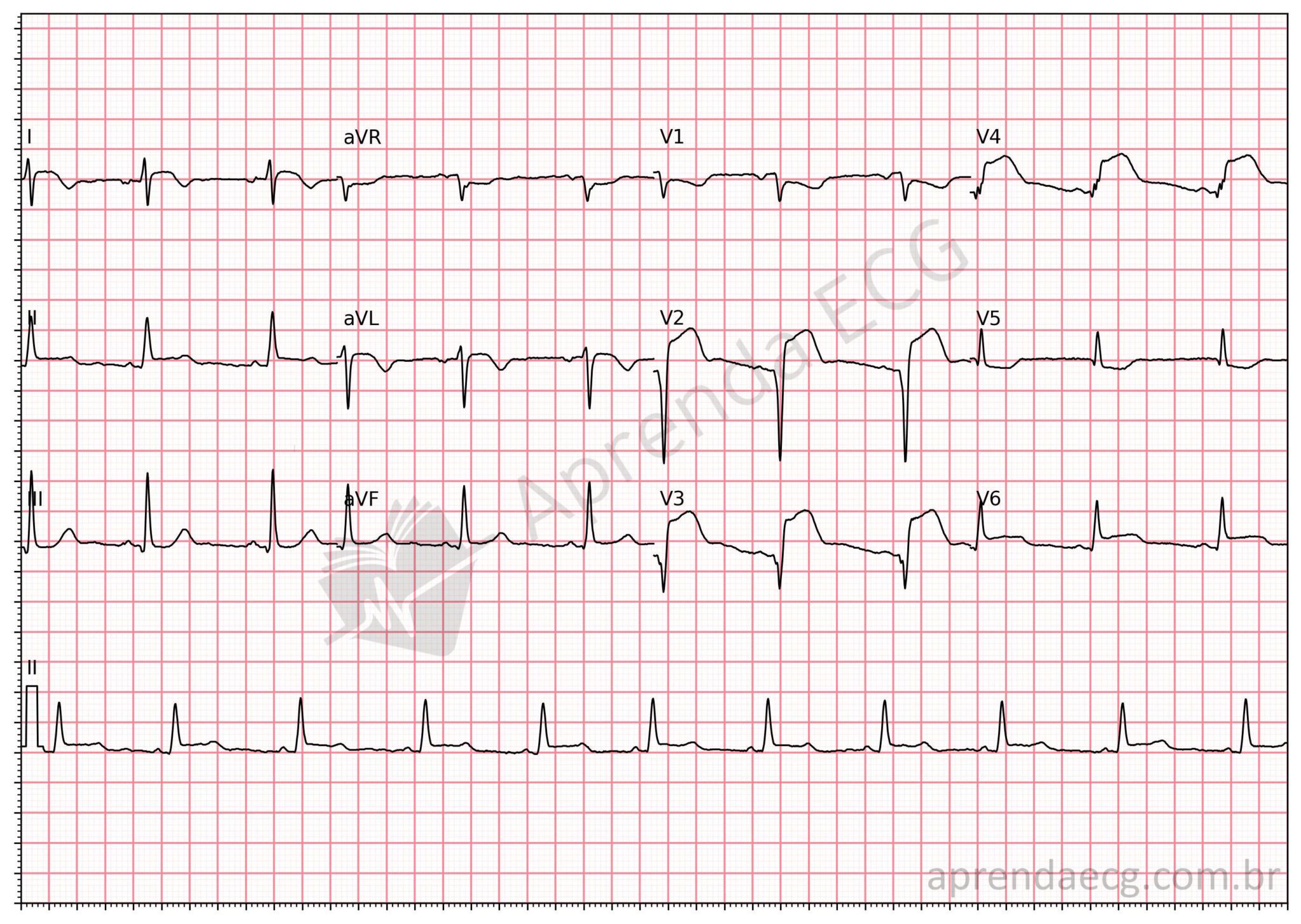 Supradesnivelamento do Segmento ST - Aprenda ECG