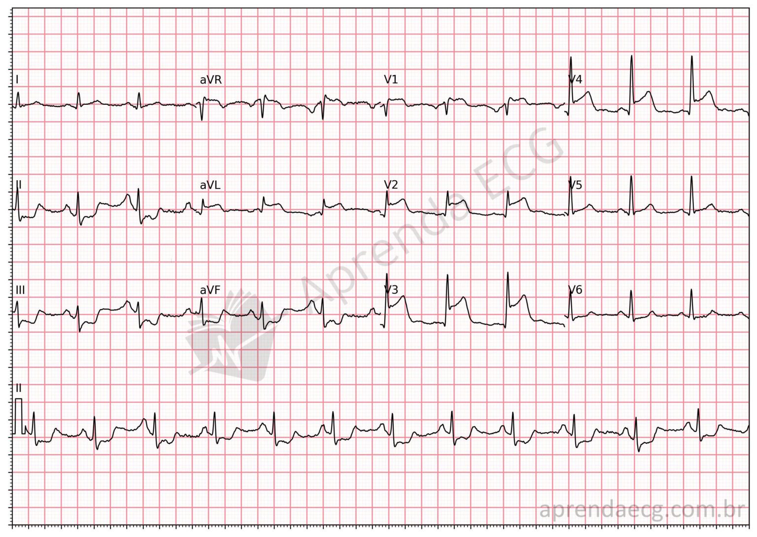Supradesnivelamento do Segmento ST - Aprenda ECG