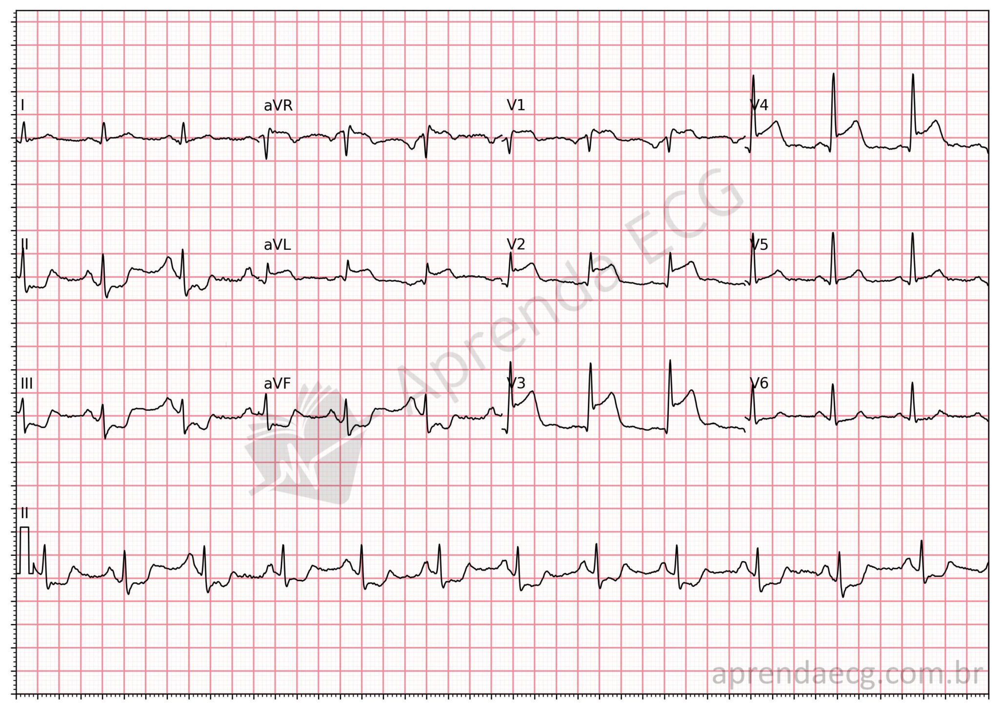 Supradesnivelamento do Segmento ST - Aprenda ECG