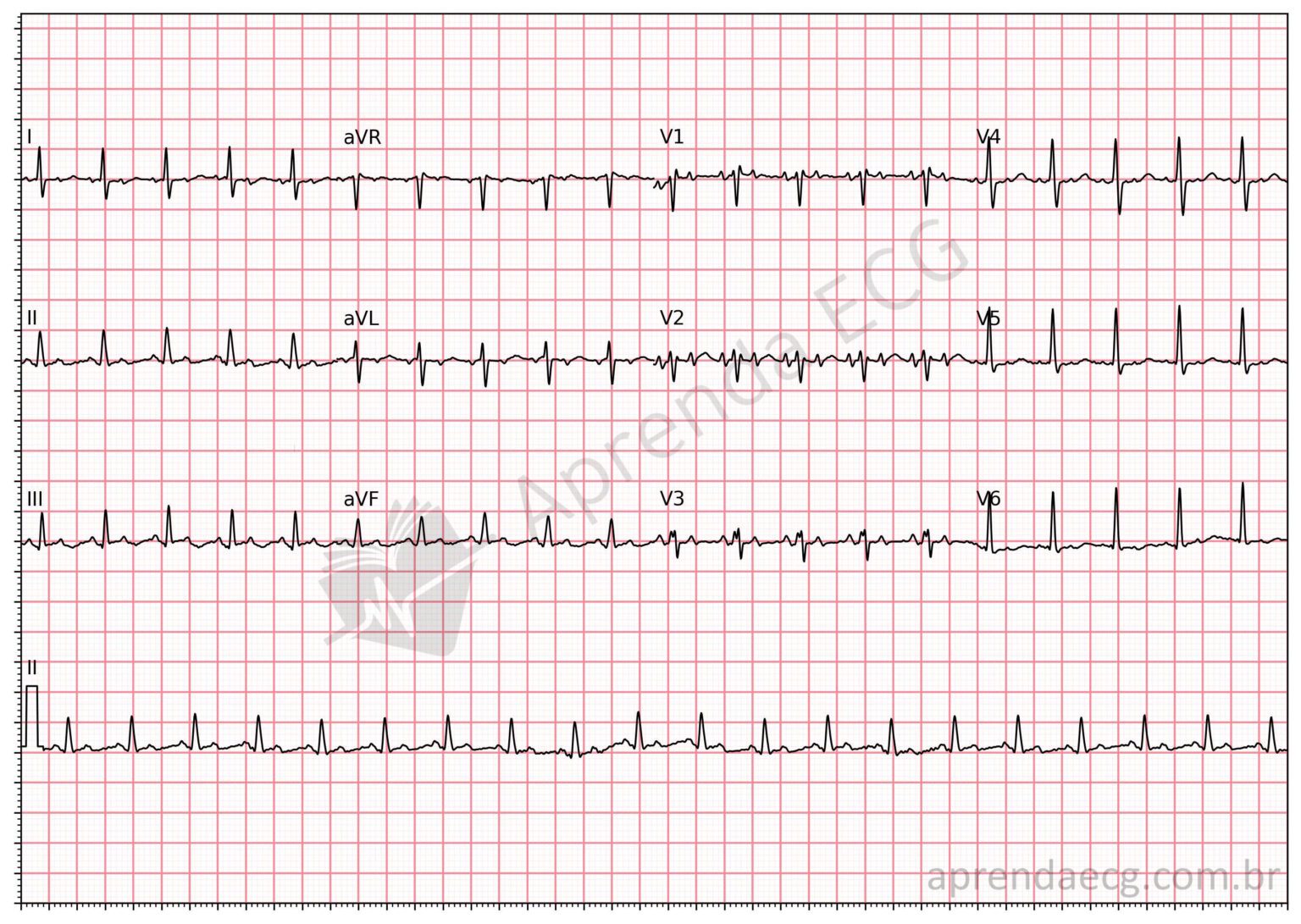 Taquicardia Atrial Focal - Aprenda ECG