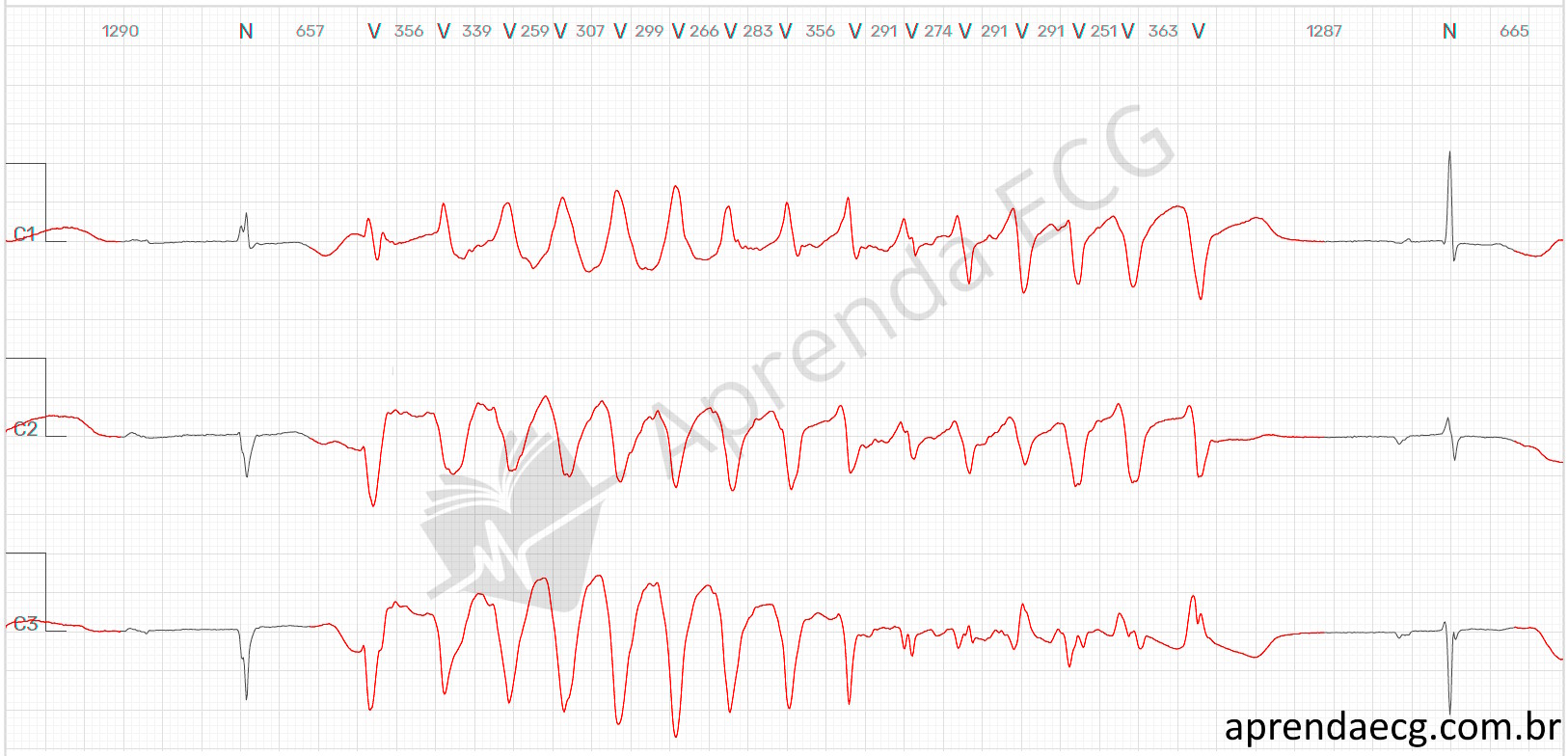 Torsades de Pointes - Aprenda ECG