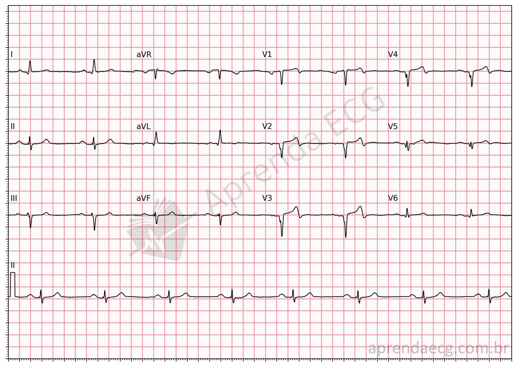Áreas Eletricamente Inativas (Ondas Q patológicas) - Aprenda ECG
