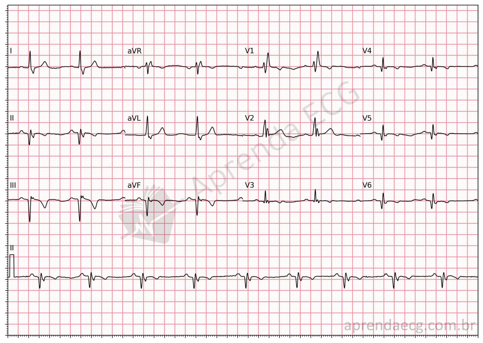 Áreas Eletricamente Inativas (Ondas Q patológicas) - Aprenda ECG