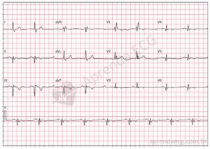 Áreas Eletricamente Inativas (Ondas Q patológicas) - Aprenda ECG