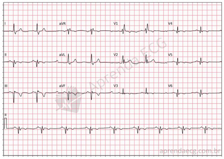Áreas Eletricamente Inativas (Ondas Q patológicas) - Aprenda ECG