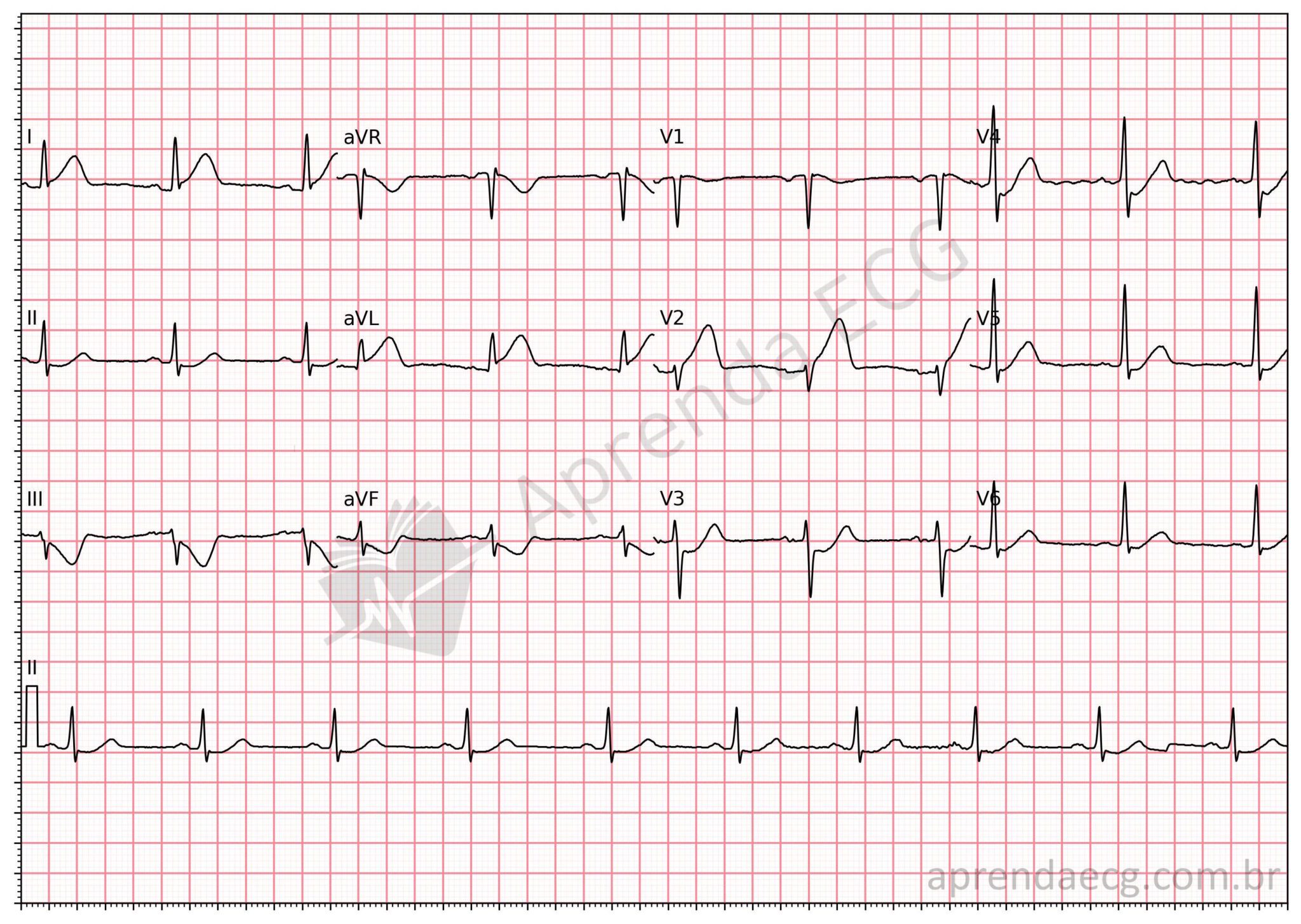 Sinal da Bandeira da África do Sul - Aprenda ECG