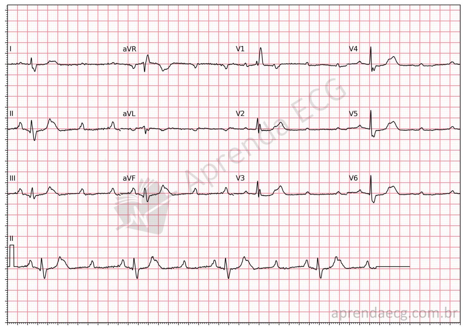 Bloqueios Atrioventriculares - Aprenda ECG