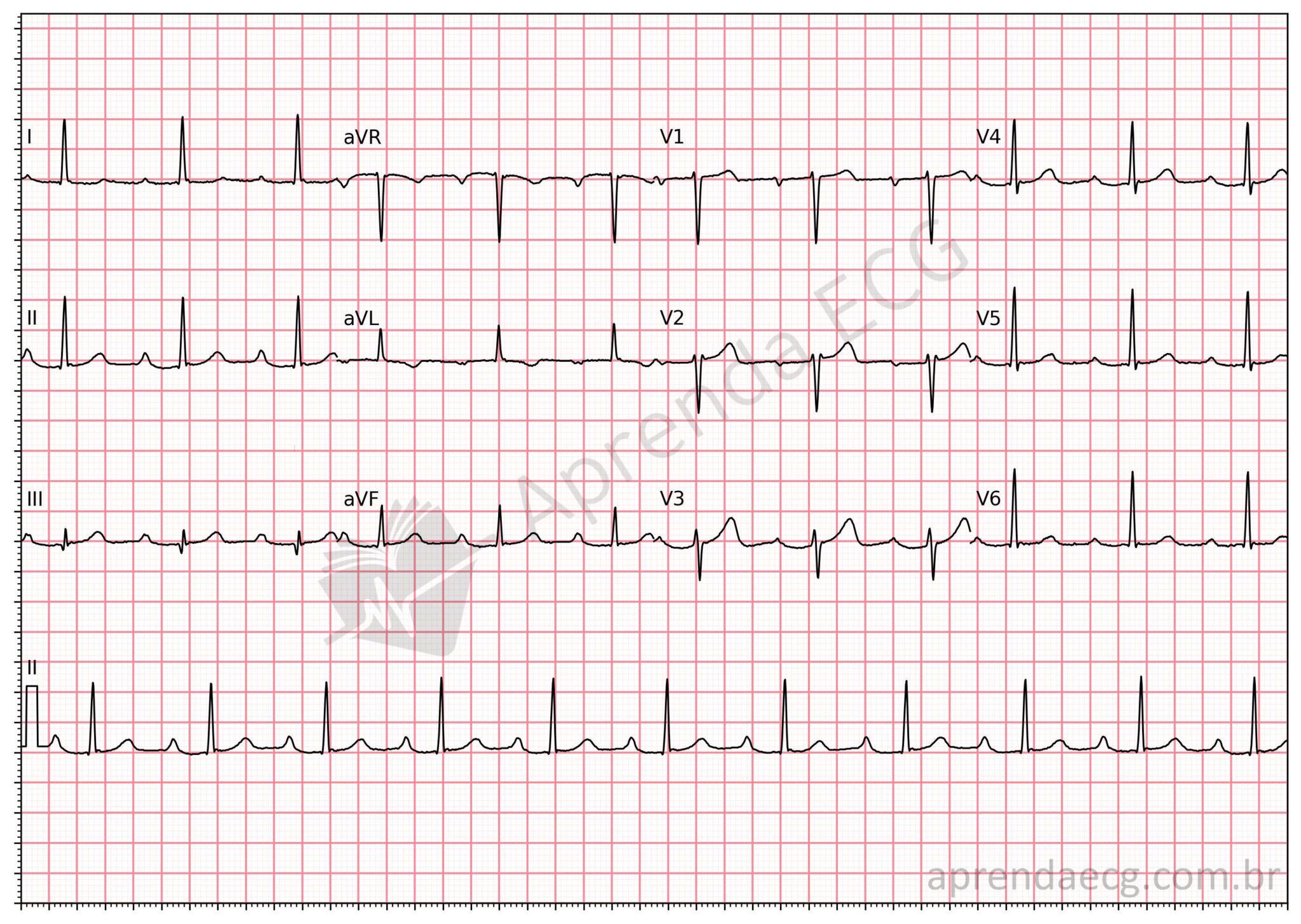 Bloqueios Atrioventriculares - Aprenda ECG