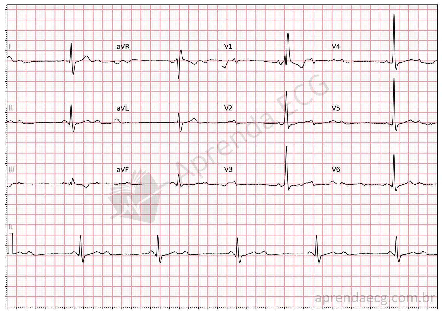 Bloqueios Atrioventriculares - Aprenda ECG