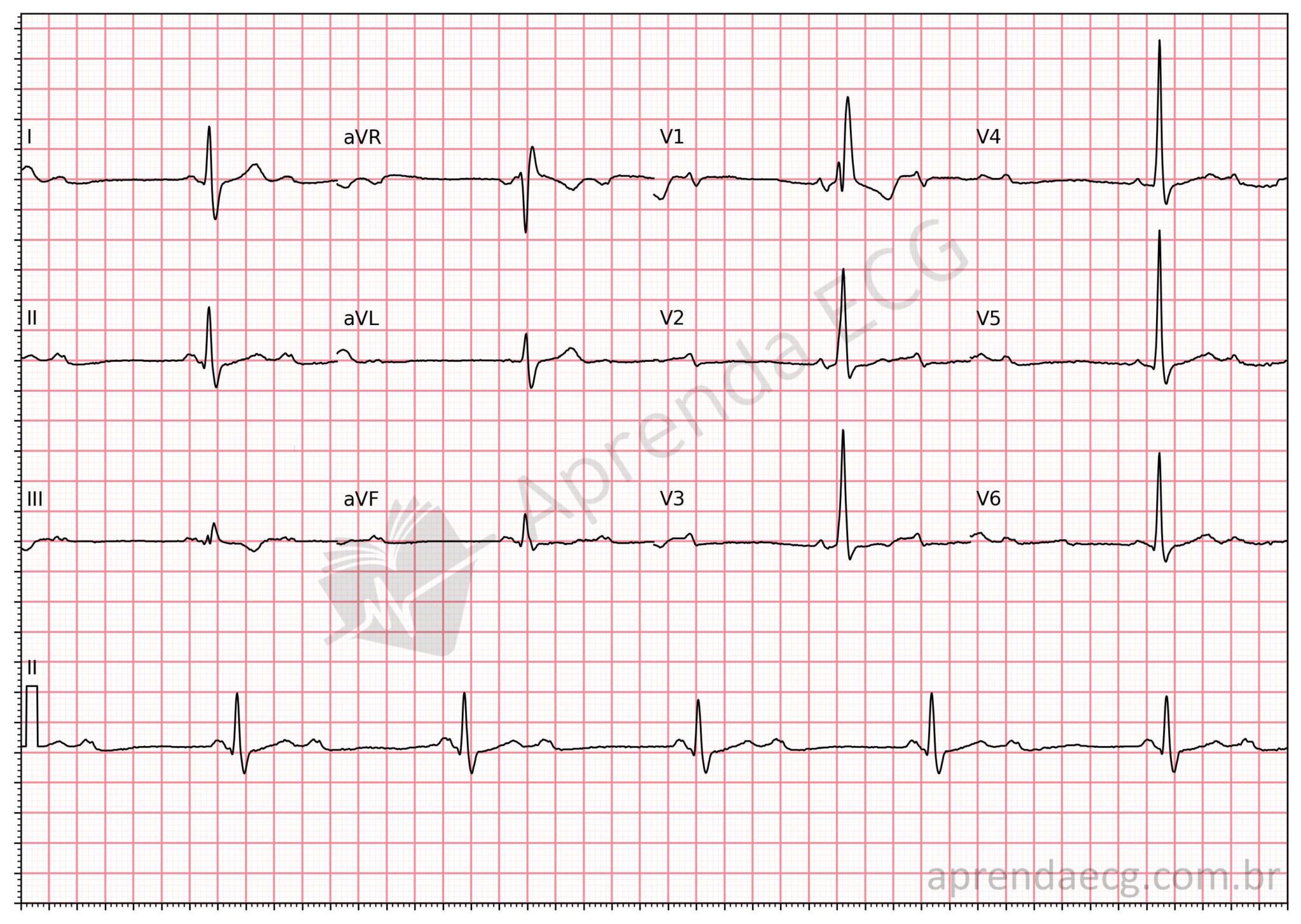 Bloqueios Atrioventriculares - Aprenda ECG