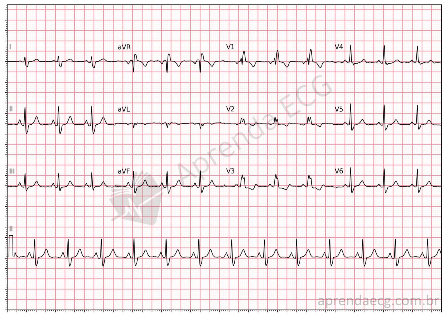 Bloqueio de Ramo Direito - Aprenda ECG