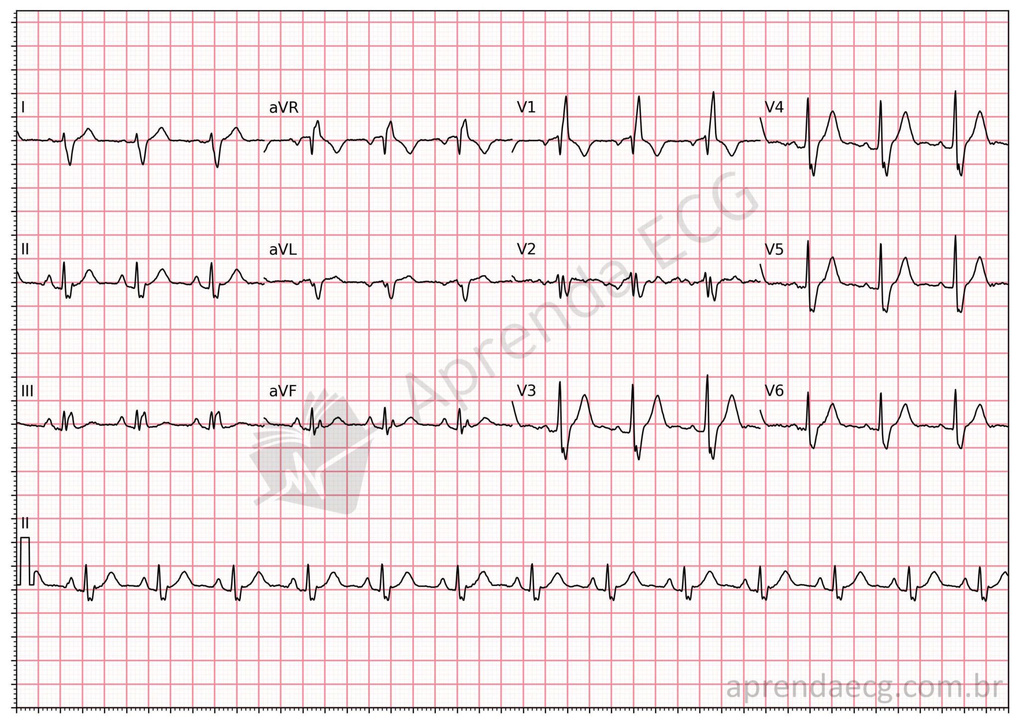 Associações de Bloqueios - Aprenda ECG