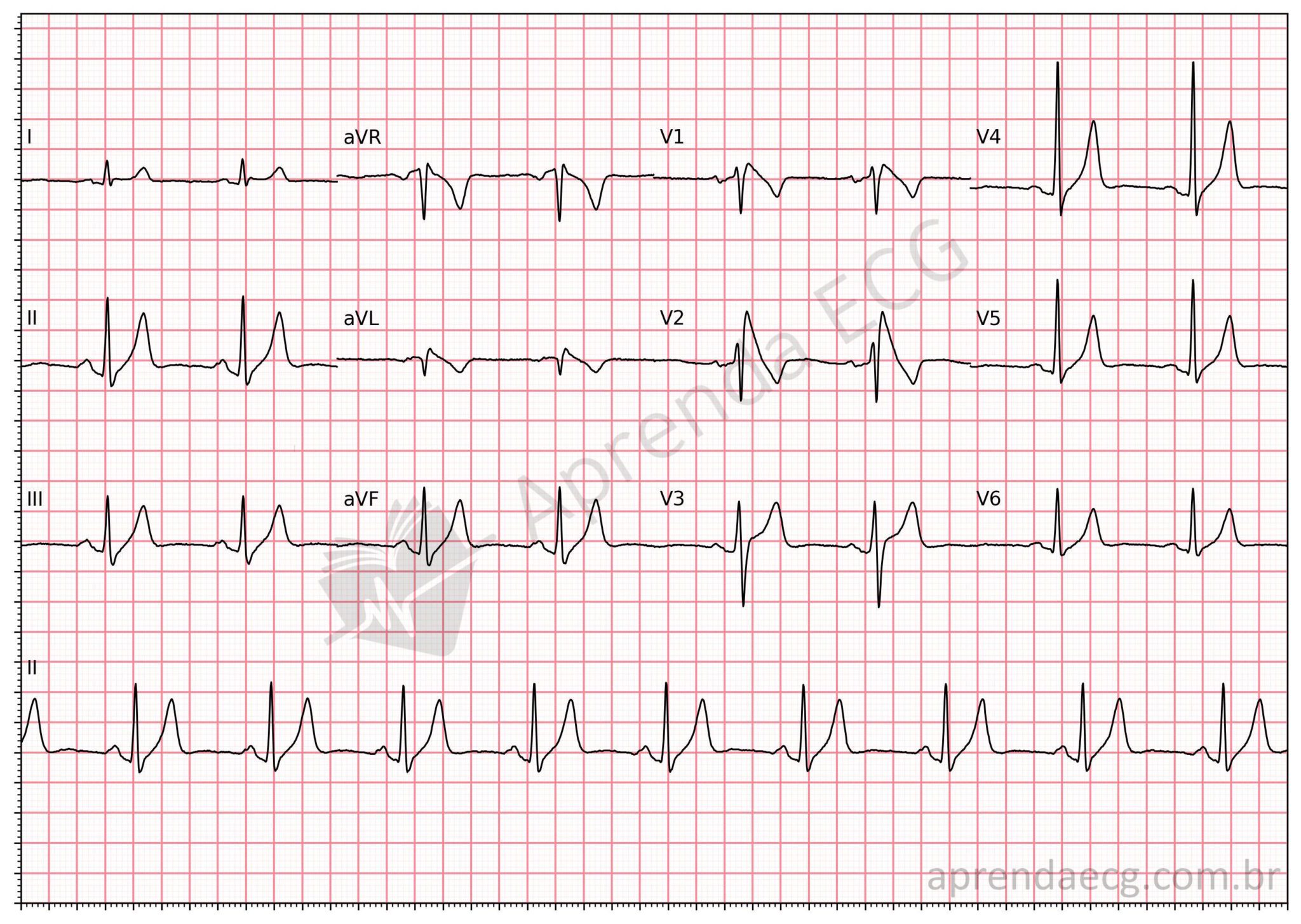 Síndrome de Brugada - Aprenda ECG