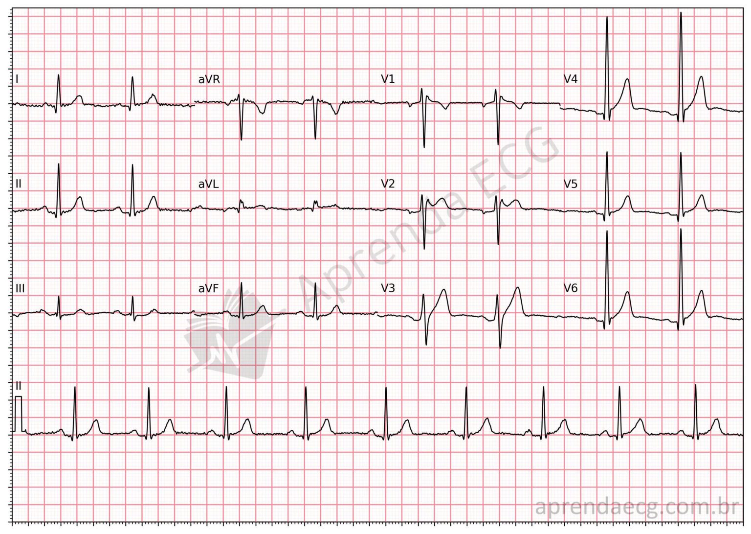 Síndrome de Brugada - Aprenda ECG