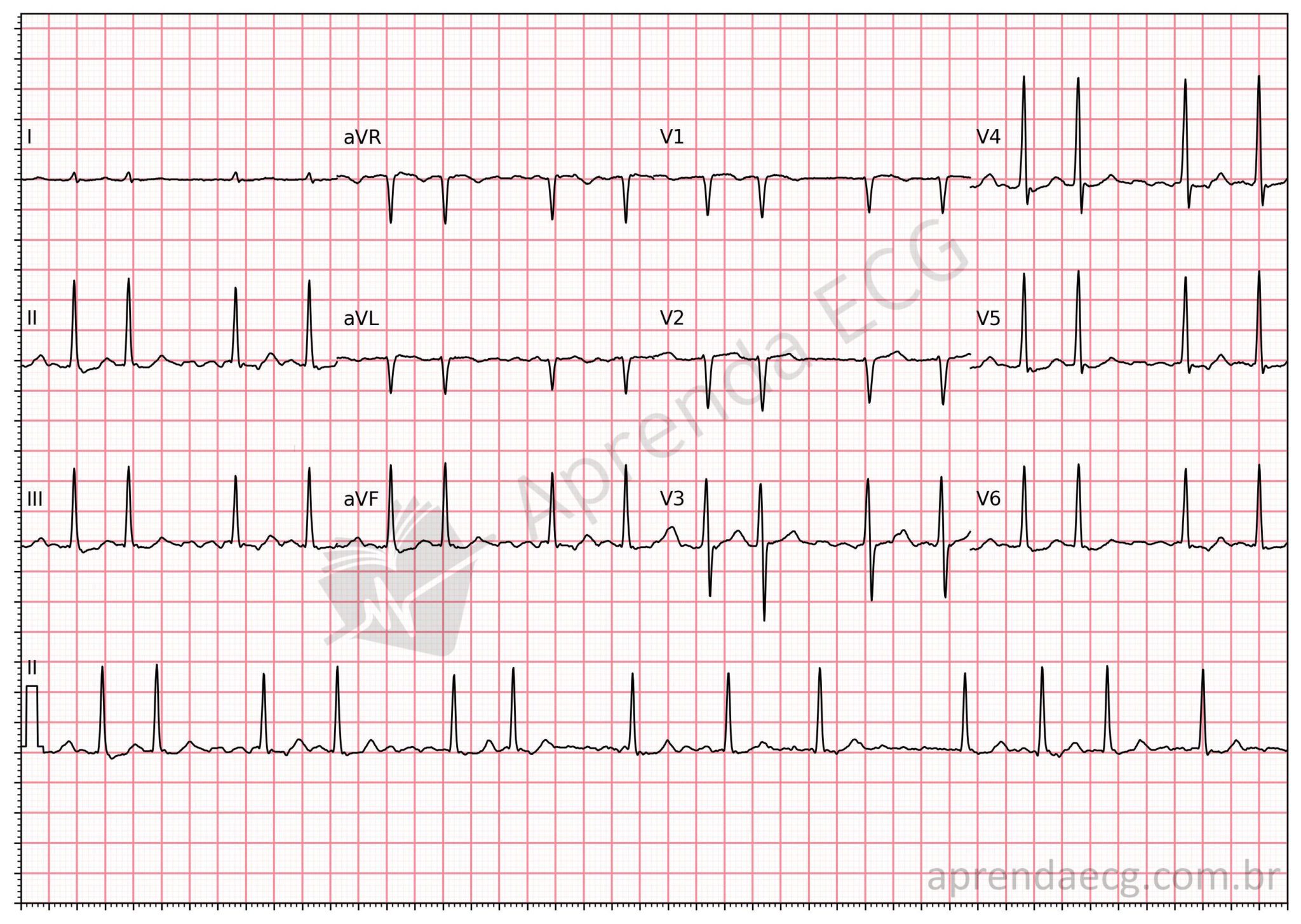 Fibrilação Atrial - Aprenda ECG