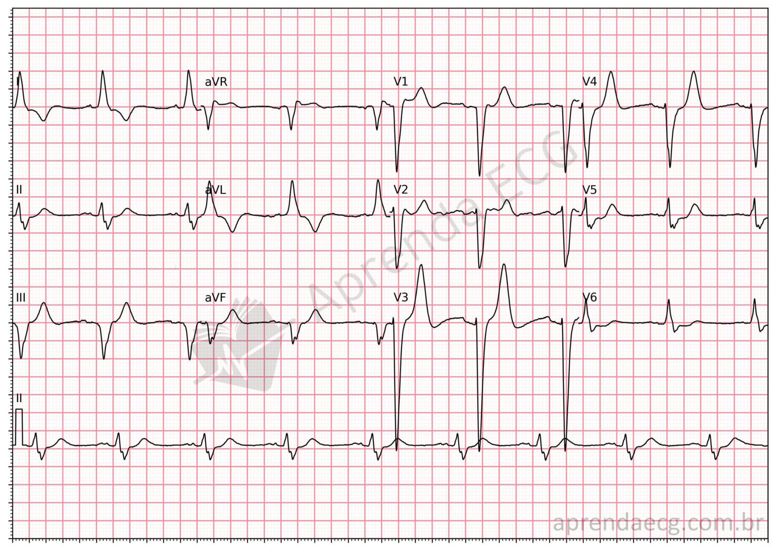 Bloqueio Periférico Intraventricular - Aprenda ECG