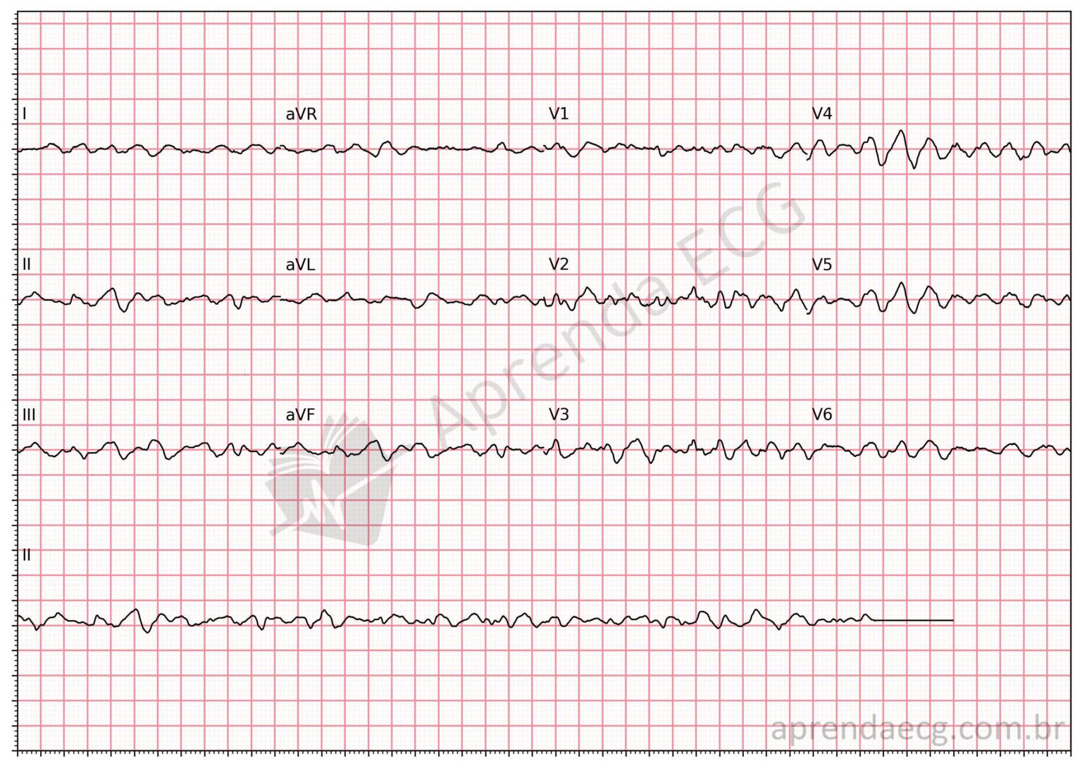 Fibrilação Ventricular - Aprenda ECG