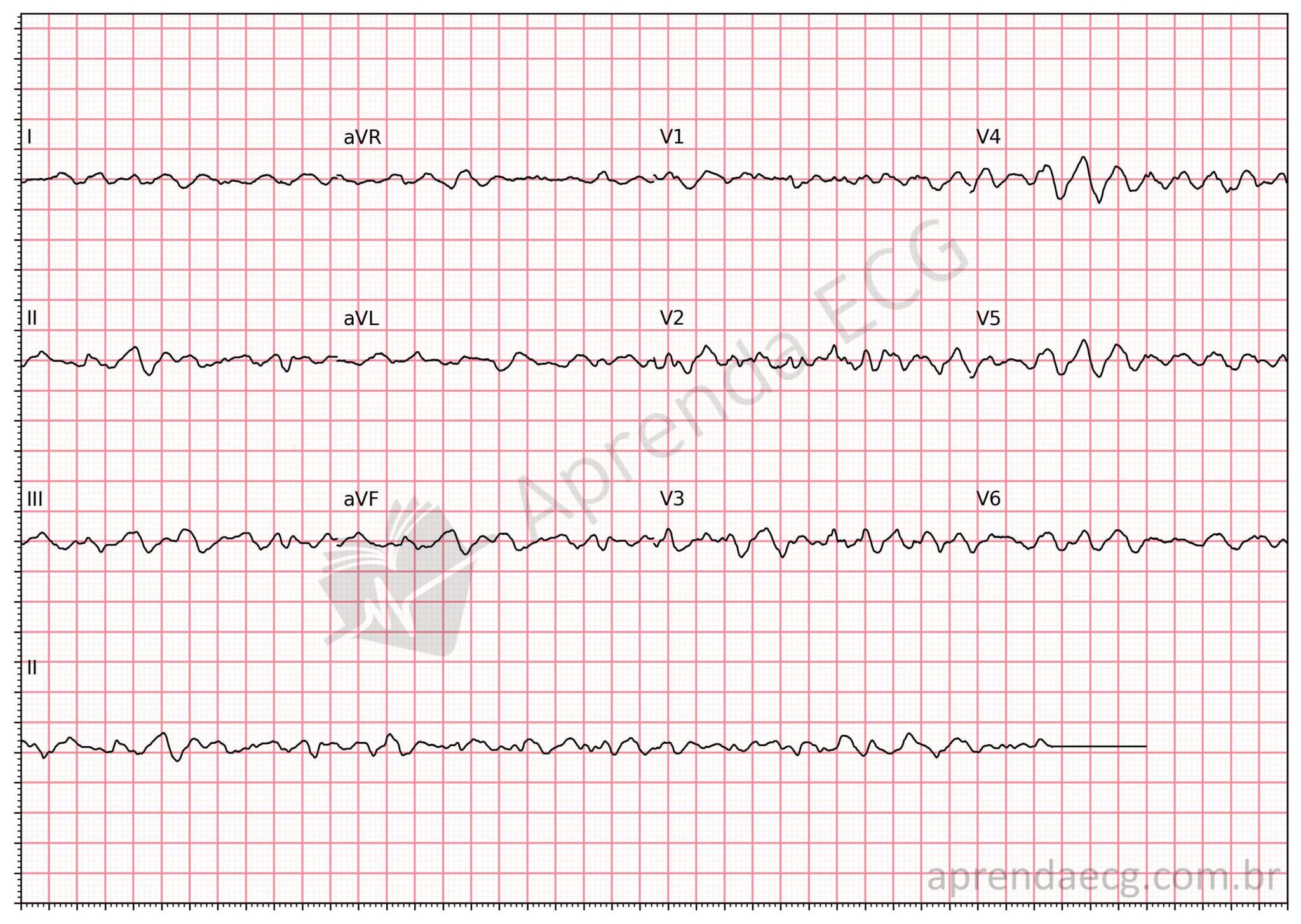 Fibrilação Ventricular - Aprenda ECG