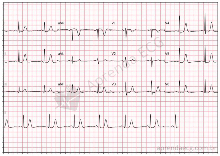 Hipercalemia - Aprenda ECG