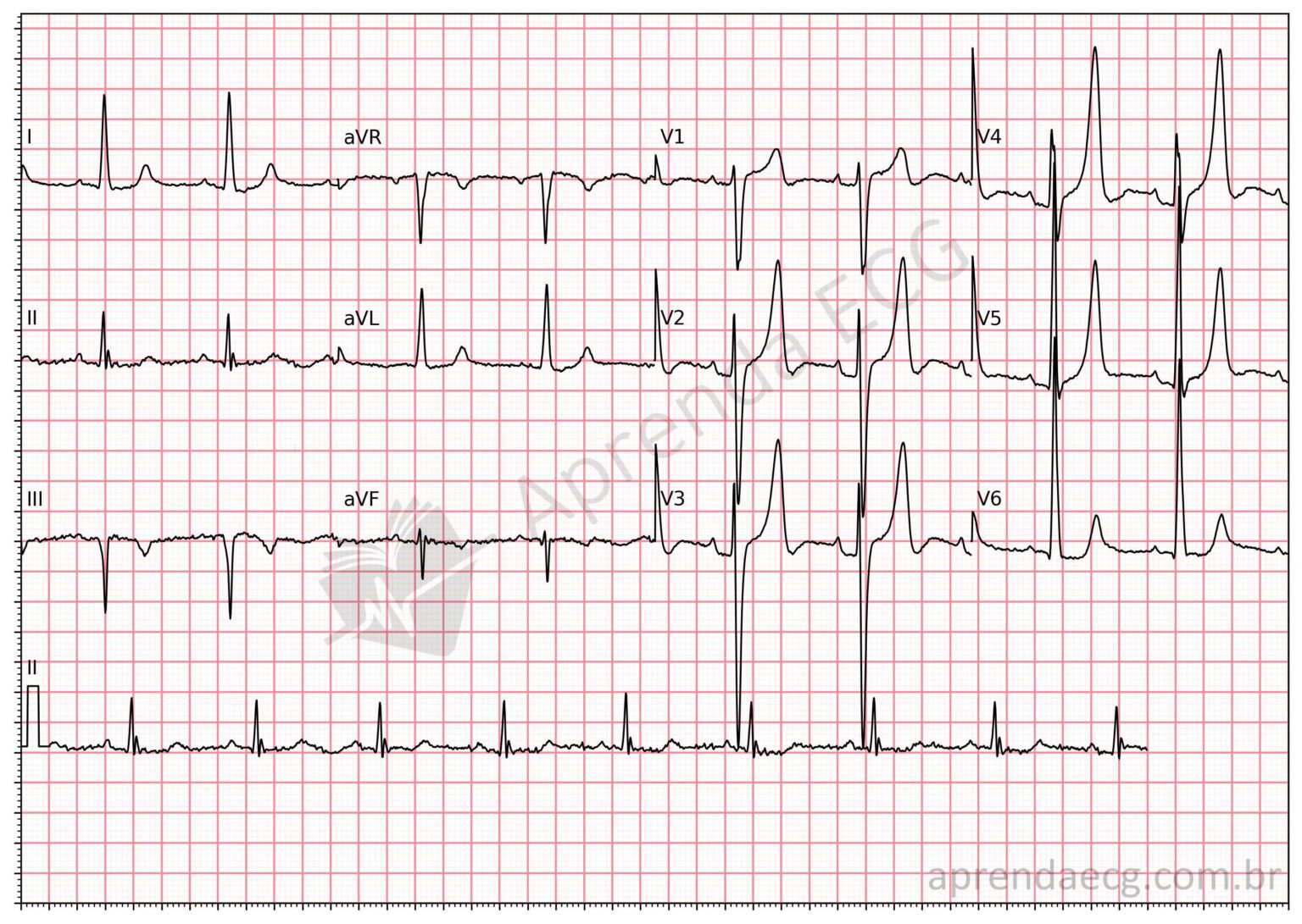 Hipercalemia - Aprenda ECG