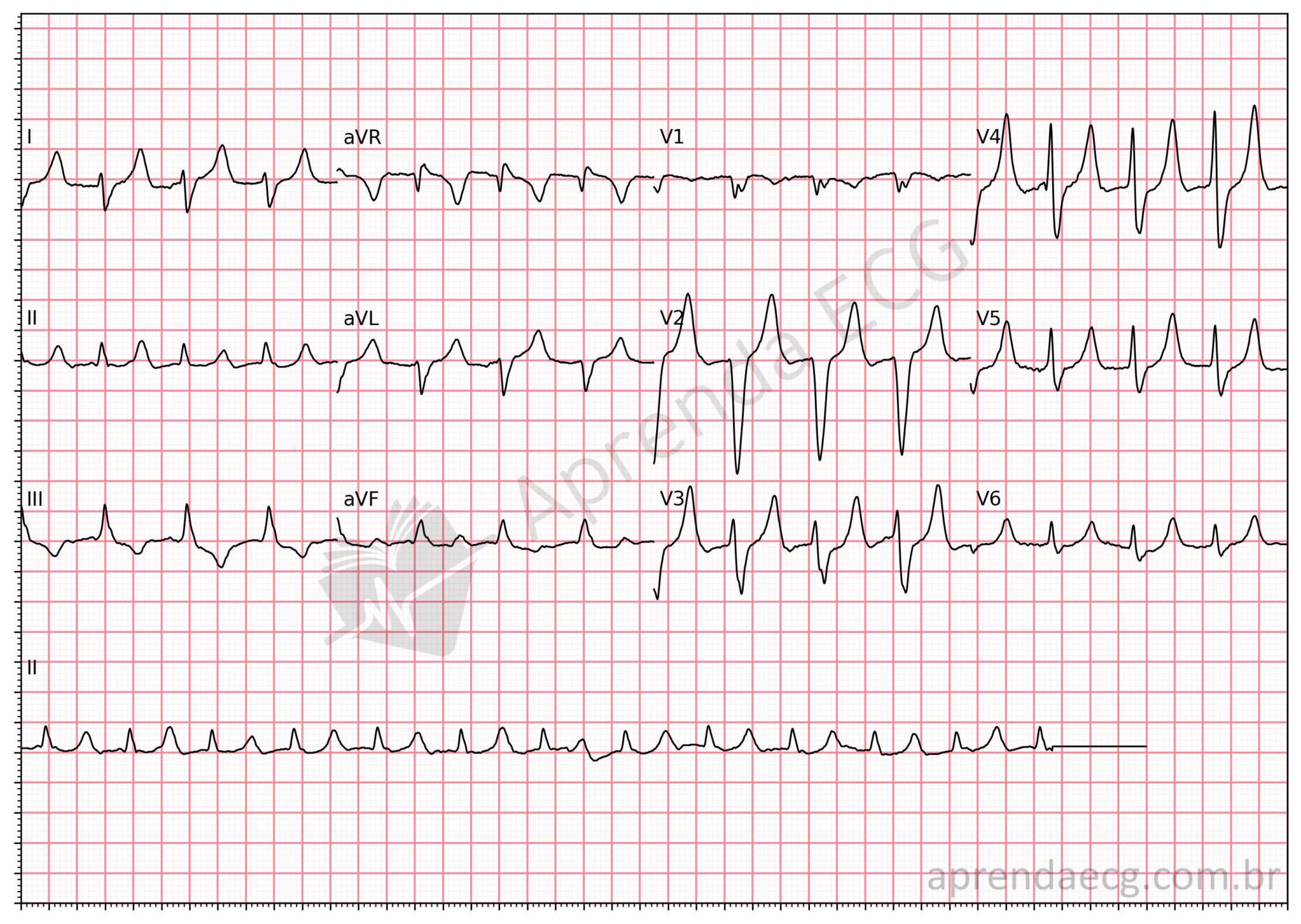 Hipercalemia - Aprenda ECG