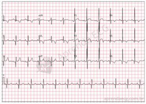 Cardiomiopatia Hipertrófica - Aprenda ECG