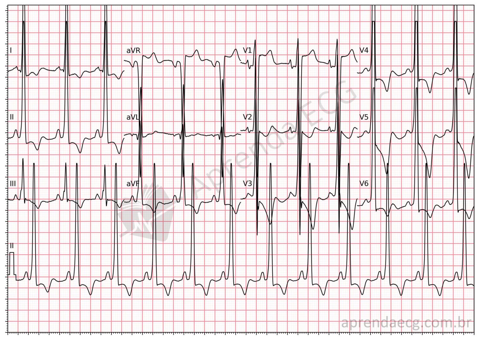 O Papel Crucial do ECG na Cardiomiopatia Hipertrófica - Aprenda ECG