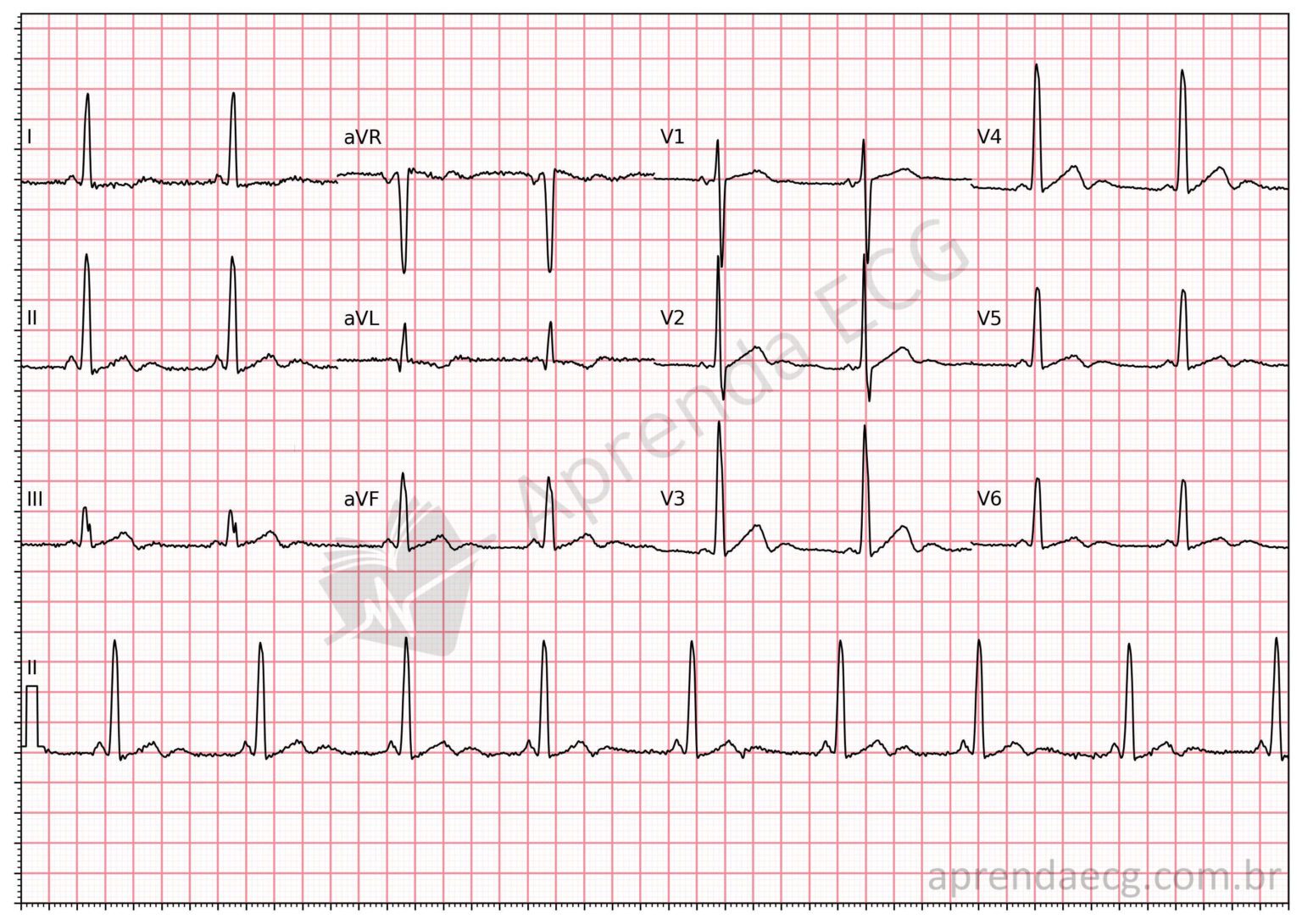 Hipocalemia - Aprenda ECG | Doctor Quest