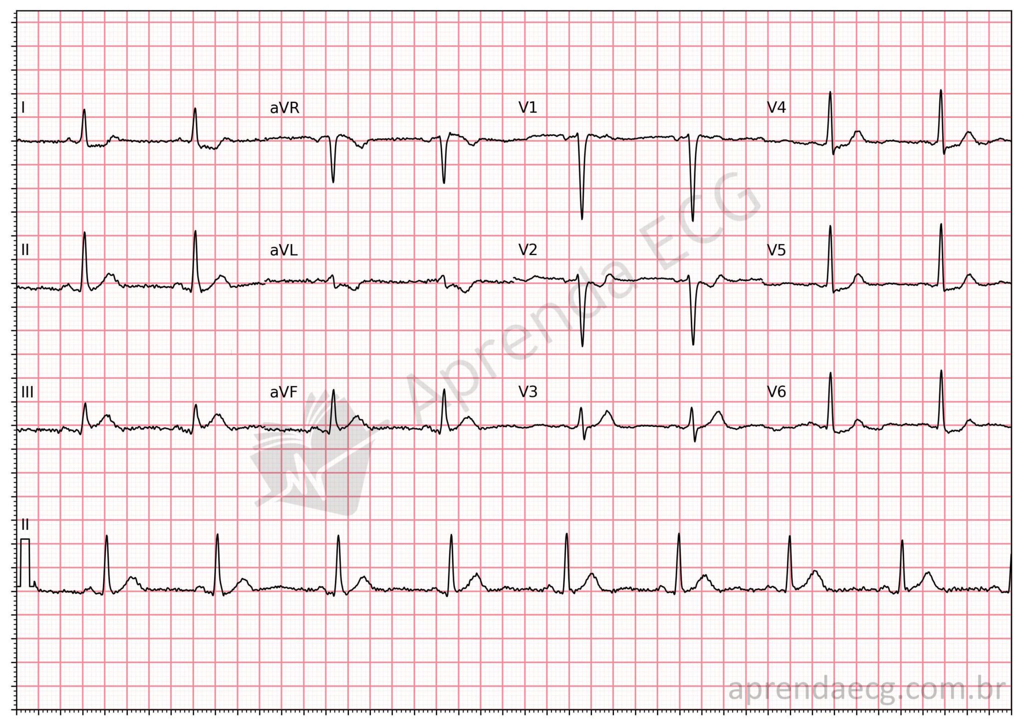 Infradesnivelamento de aVL - Aprenda ECG