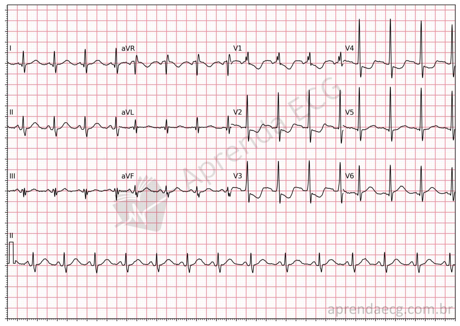 Infradesnivelamento de V1 a V3 - Aprenda ECG