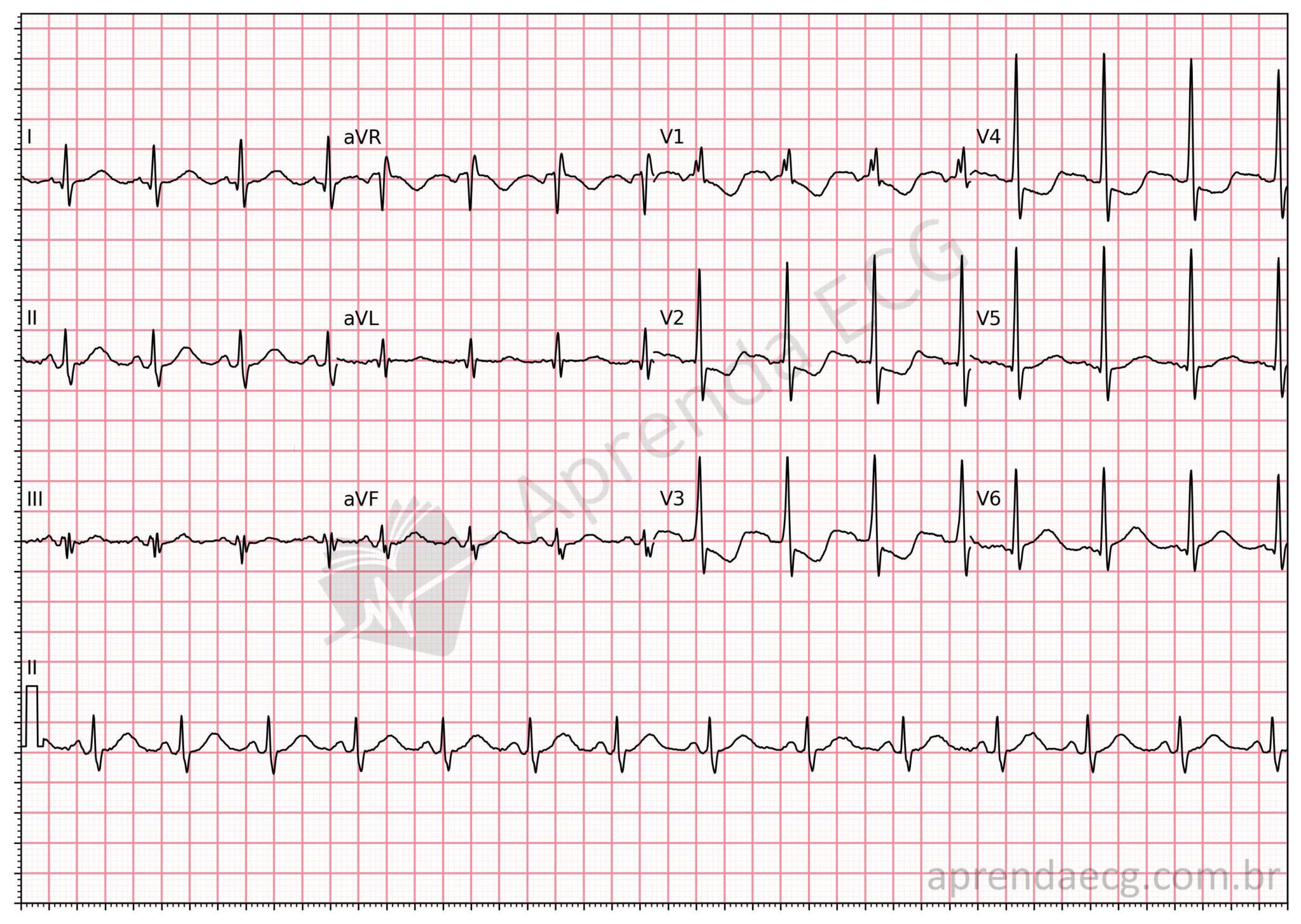 Infradesnivelamento de V1 a V3 - Aprenda ECG